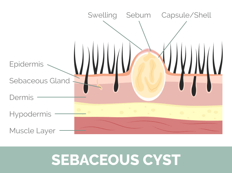 Sebaceous Cyst Diagram Sebaceous Cyst Diagram